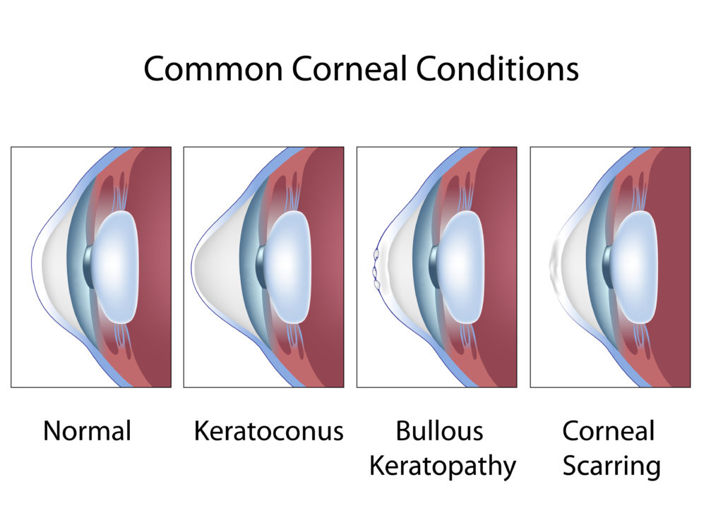Corneal Disease Hendersonville | Cornea Specialist Asheville